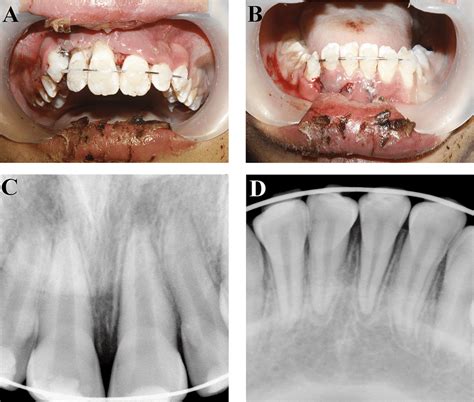 A B Clinical Appearance Of Wire Composite Splinting Of Maxillary And Download Scientific