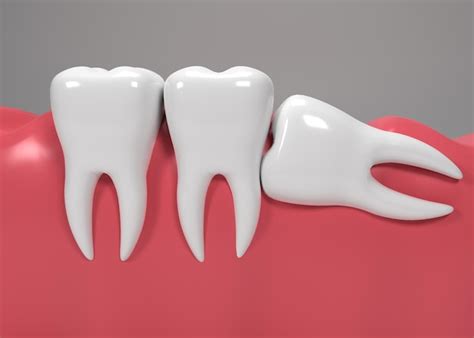 Premium Photo 3d Render Of Teeth With Wisdom Mesial Impaction