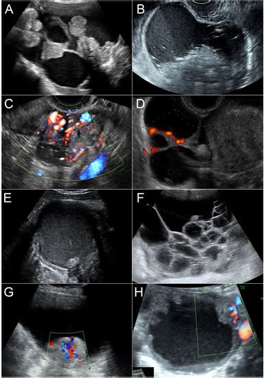 Comparisons Of Effectiveness In Differentiating Benign From Malignant