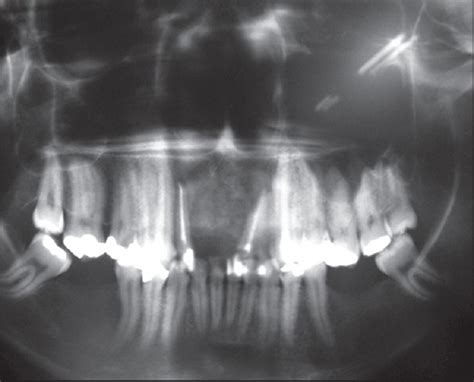 Chondroblastic Osteosarcoma Abstract Europe Pmc
