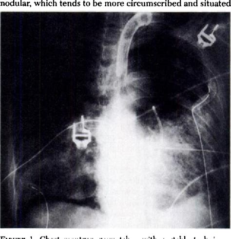 Figure 1 From Extensive Diffuse Pulmonary Ossification Semantic Scholar