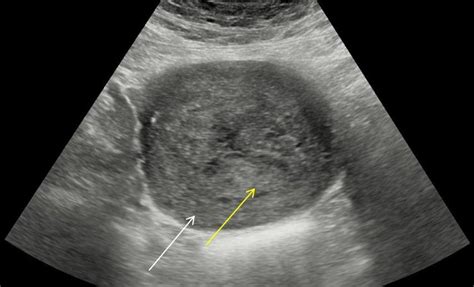 An Unusual Obstetric Event Postpartum Uterine Inversion Eurorad