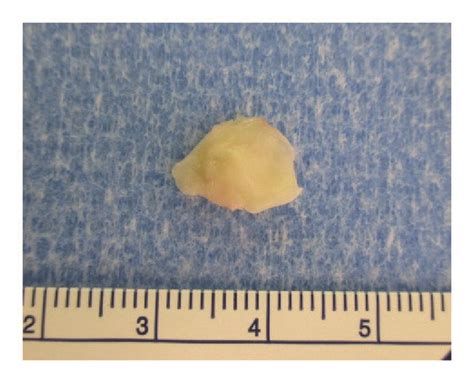 Surgical Resection Of The Plantar Capsular Accessory Ossicle At The Download Scientific Diagram