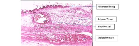 Describe The Dermoid Cyst Wall With A Completely Attenuated Lining