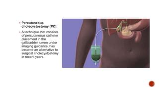 Cholelithiasis Gallstones Pptx