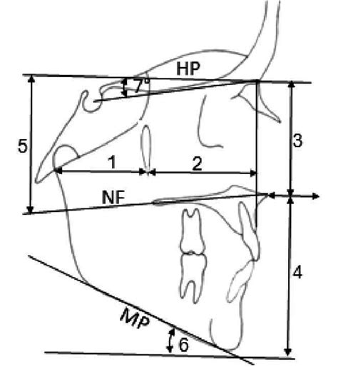 Cranial Base Length And Vertical Skeletal Measurements 1 Posterior