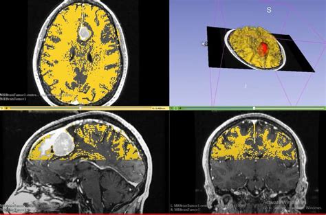 medical scans segmentation and 3d modeling freelancer
