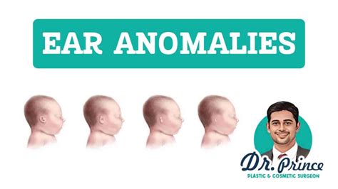 Ear Anomalies Topplasticsurgery