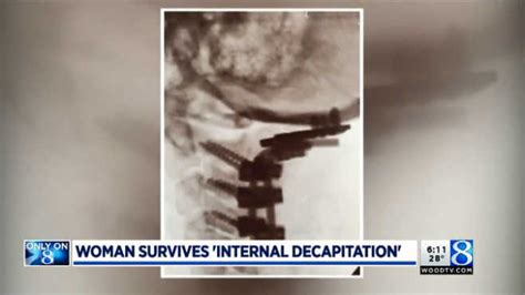 Michigan Woman Survives Internal Decapitation