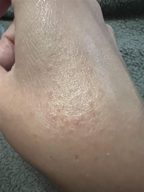 Brown Scaly Spots On Hand Rmedicaladvice
