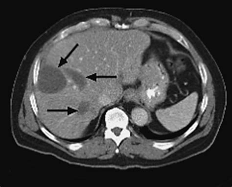 Metástasis Hepática Dr Frans Serpa Larrea Cáncer De Hígado