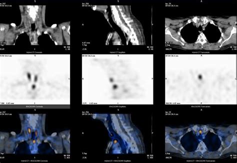 Ectopic Thyroid Pacs
