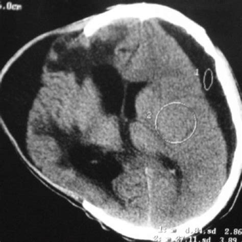 Subdural Effusion On The Left Download Scientific Diagram