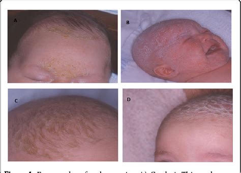 Figure 1 From Efficacy And Safety Of A Topical Pediatric Gel In Infants