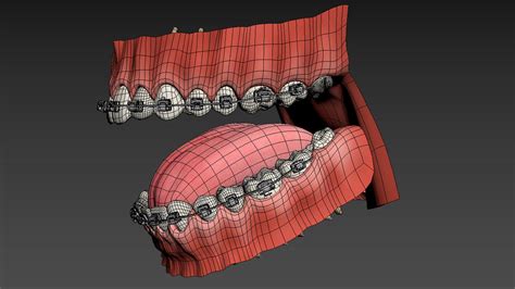 3d Model Mouth Teeth Set Braces Brackets Vr Ar Low Poly Cgtrader