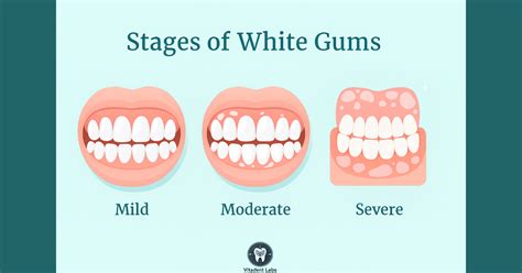 White Gums Around Teeth Vitamin Deficiency Guide