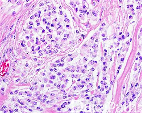小圆细胞肿瘤蝶窦存第11页大山谷图库