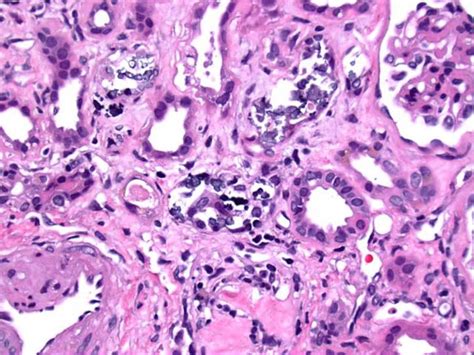 Fileacute Phosphate Nephropathy Calcium Phosphate Crystal Deposition