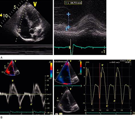 The Physiologic Basis Of Right Ventricular Echocardiography Clinical Tree
