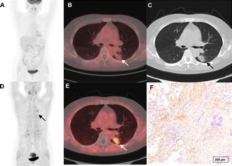 A 60 Year Old Female With A Partial Solid Nodule In The Lower Lobe Of