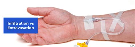 Iv Infiltration Signs