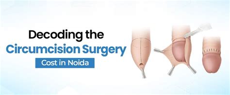 Decoding Circumcision Surgery Cost In Noida In 2025 Circumcision Surgery Medical Services