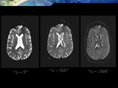 PPT DIFFUSION PERFUSION MRI IMAGING PowerPoint Presentation ID