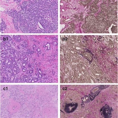 Validation Of Elastosis Scoring In Hande 1 Stained Sections By Parallel