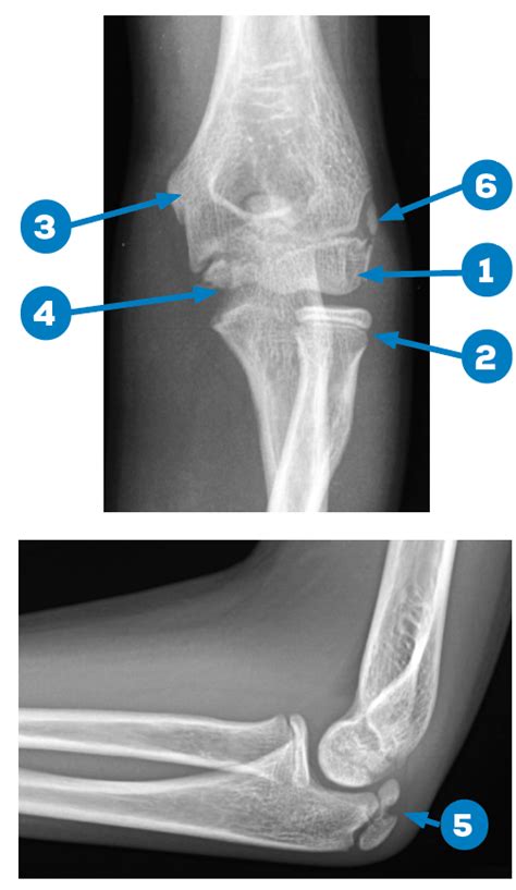 Elbow Joint X Ray