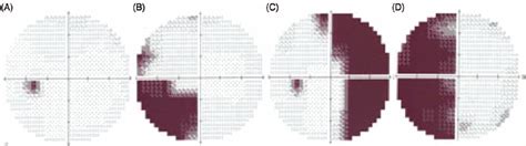 Left Eye Visual Fields From Example Participants Black Regions Show