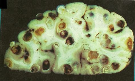 Tapeworms On The Brain
