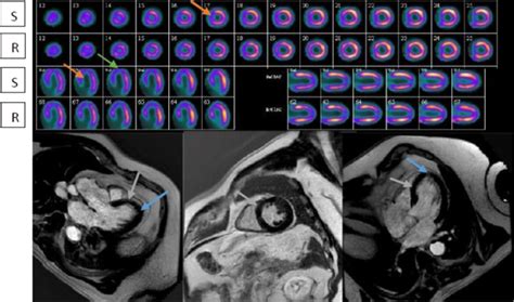 Fixed Perfusion Defect Of The Apex And Septum On Spect Suggests Download Scientific Diagram