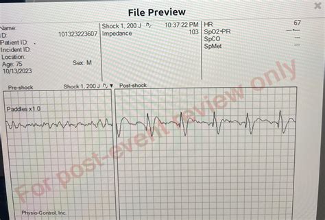 V Fib Converted R Paramedics