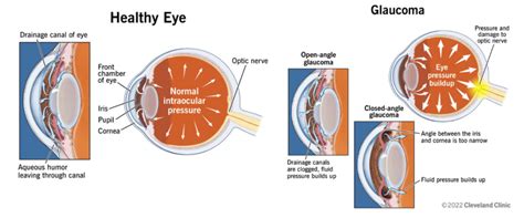 Glaucoma Vs Cataracts Which Eye Condition Are You At Risk For