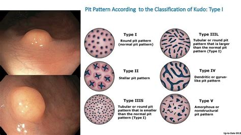 Identify The Pit Pattern Of This Polyp Endocollab™ Gastroenterology