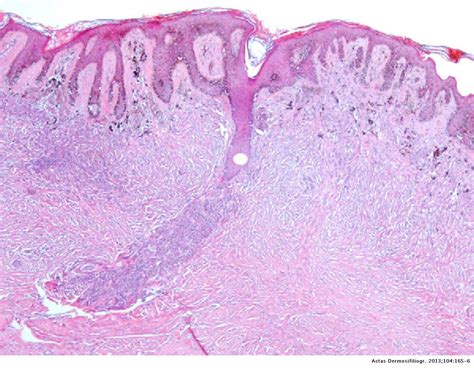 Lichen Simplex Chronicus Histology