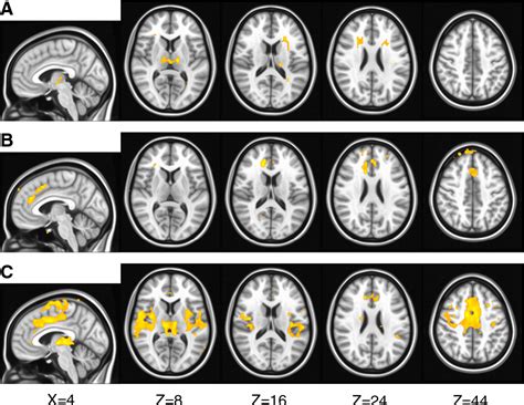Eegfmri Contributions To Our Understanding Of Genetic Generalized Epilepsies Semantic Scholar