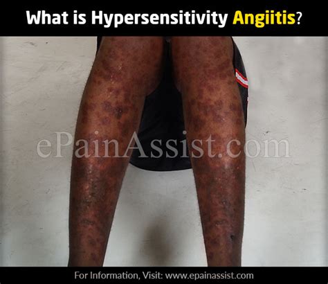 What Is Hypersensitivity Angiitis And How Is It Treated Causes Symptoms