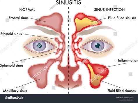 Maxillary Sinus Inflammation