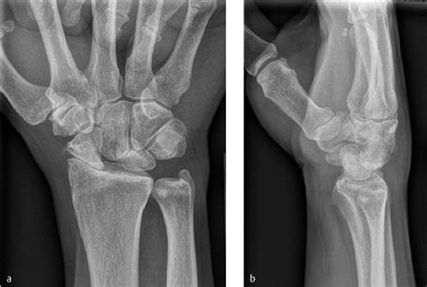 59 Scaphoidectomy And Four Corner Fusion Plastic Surgery Key