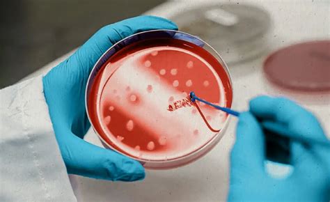 Small Cell Lung Cancer Comprehensive Guide To Symptoms Stages