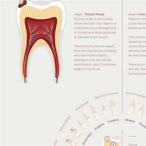 Stages Of Tooth Decay Educaredesign