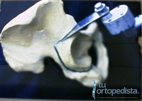 Osteotomía Tipo Ganz En Cadera Pediatrica Tuortopedista