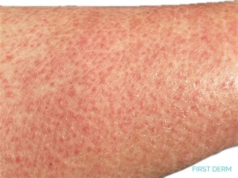 Drugs Acting On Skin