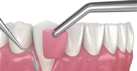 What Should We Know About Gingival Plastic Surgery