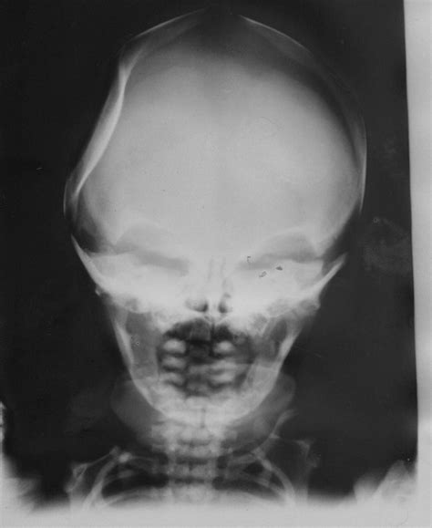 Ping Pong Skull Fracture In Neonate R Radiology