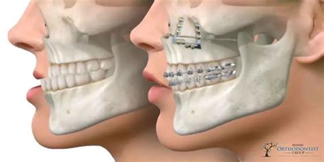 Improving Oral Health The Role Of Orthognathic Surgery In Bite Issues