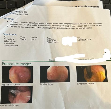 First Colonoscopy And Might Be Ibd Rulcerativecolitis