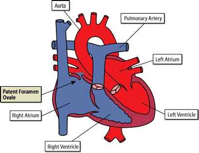 Patent Foramen Ovale