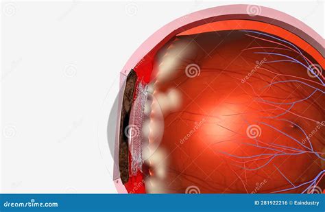 Pars Planitis Is An Eye Disease Where The Middle Layer Of The Eye Called The Uvea Becomes